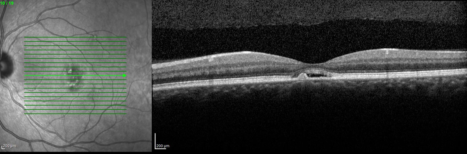 Chorioretinite Sereuse Centrale (CRSC) - Centre Ophtalmologique des ...