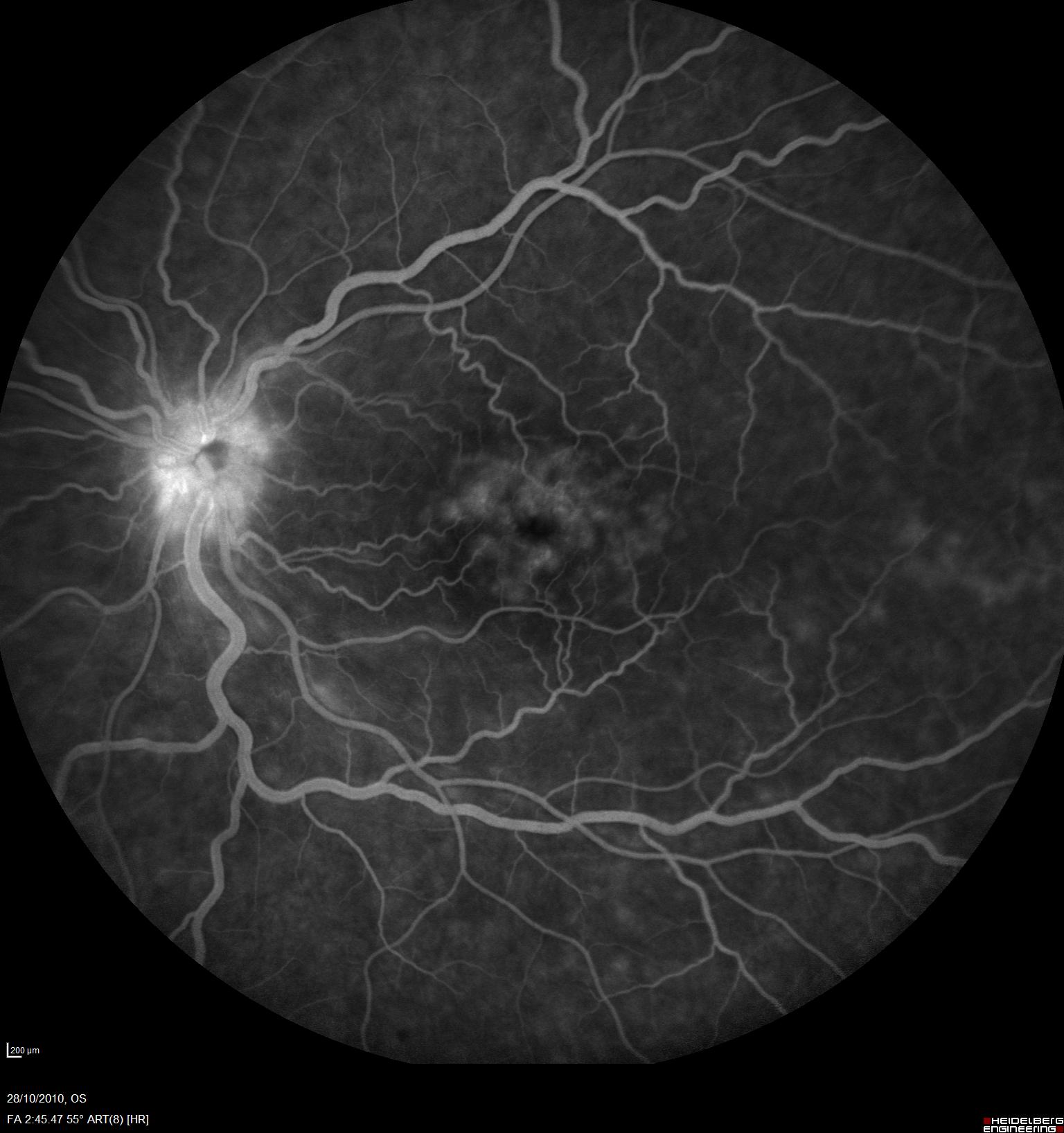 Uvéites & inflammation intraoculaire - Centre Ophtalmologique des Pyrénées